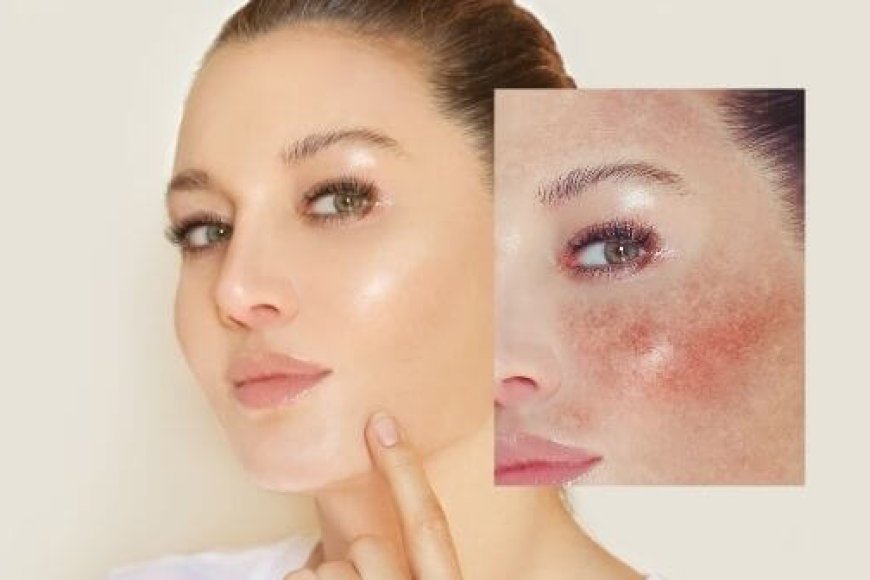 Rosacea - All Skin Problems | Expert Skin Care Tips, Treatments & Solutions