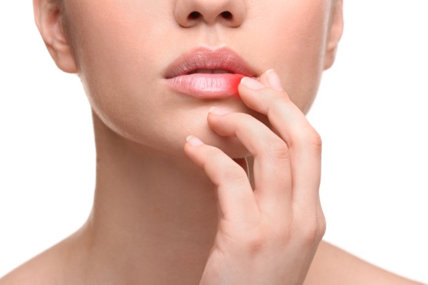 Cold Sores - All Skin Problems | Expert Skin Care Tips, Treatments ...